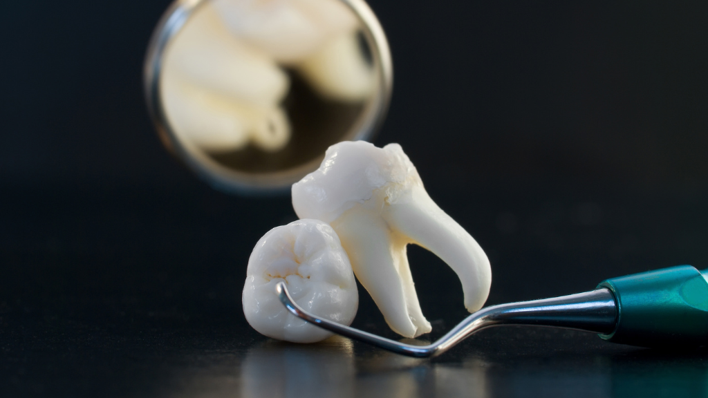 The Wisdom on Wisdom Teeth | Learn About Your Wisdom Teeth | DeCare
