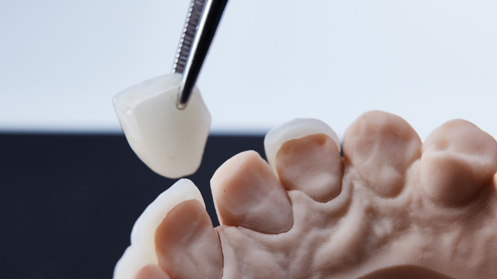 Treating Cavities in Permanent Teeth - DeCare Treating Cavities in Permanent Teeth - DeCare